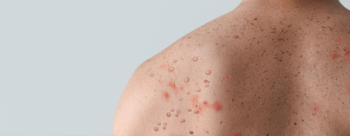 Monkeypox - What you need to know